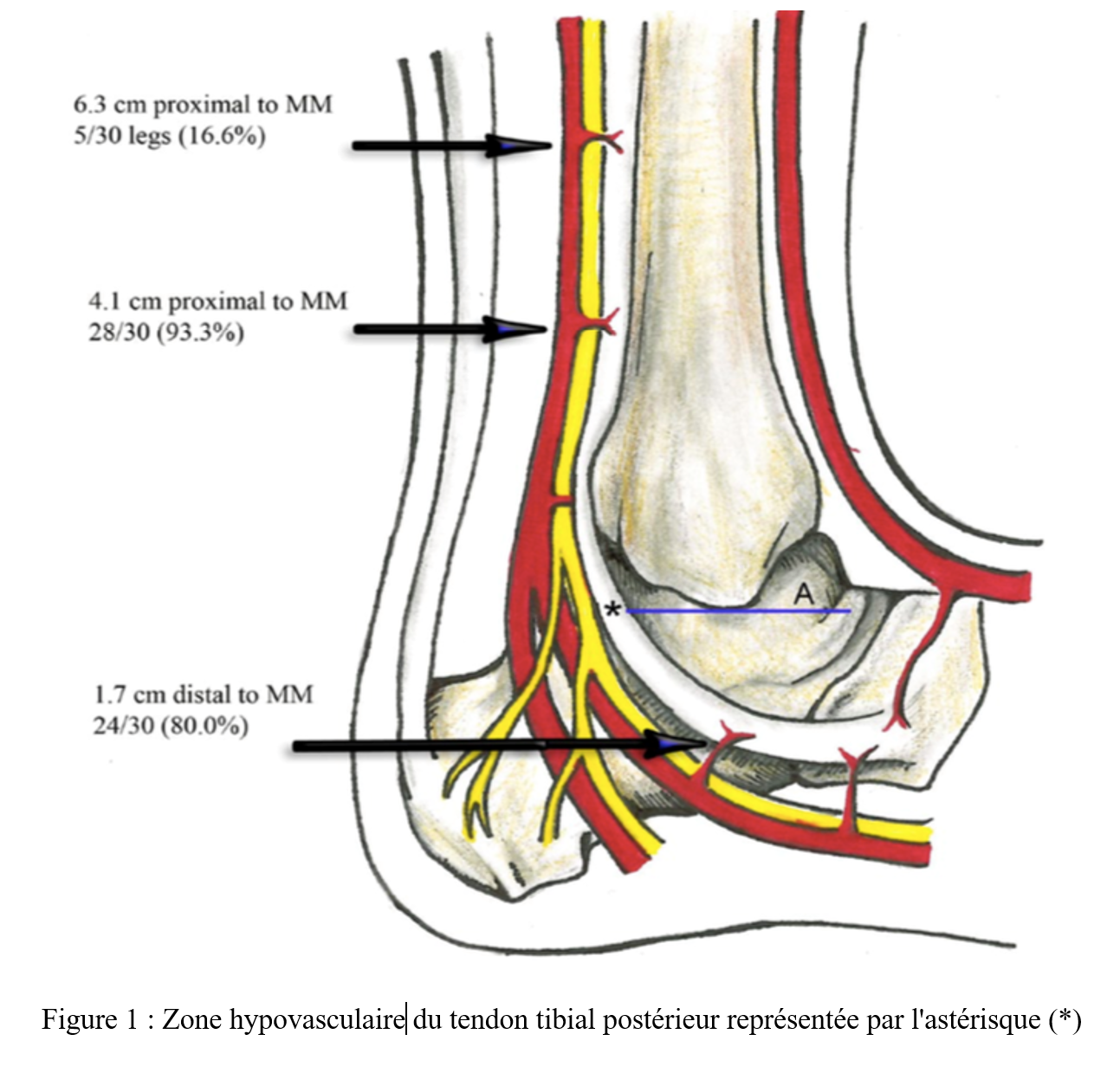 Tendinopathie ou dysfonction du tendon tibial postérieur